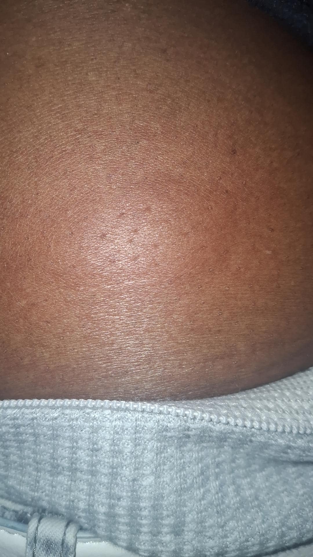 He got welps from being bit