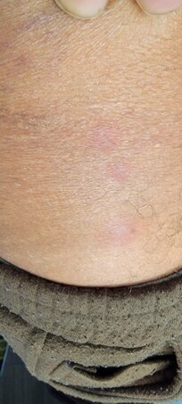 bites on my waste line