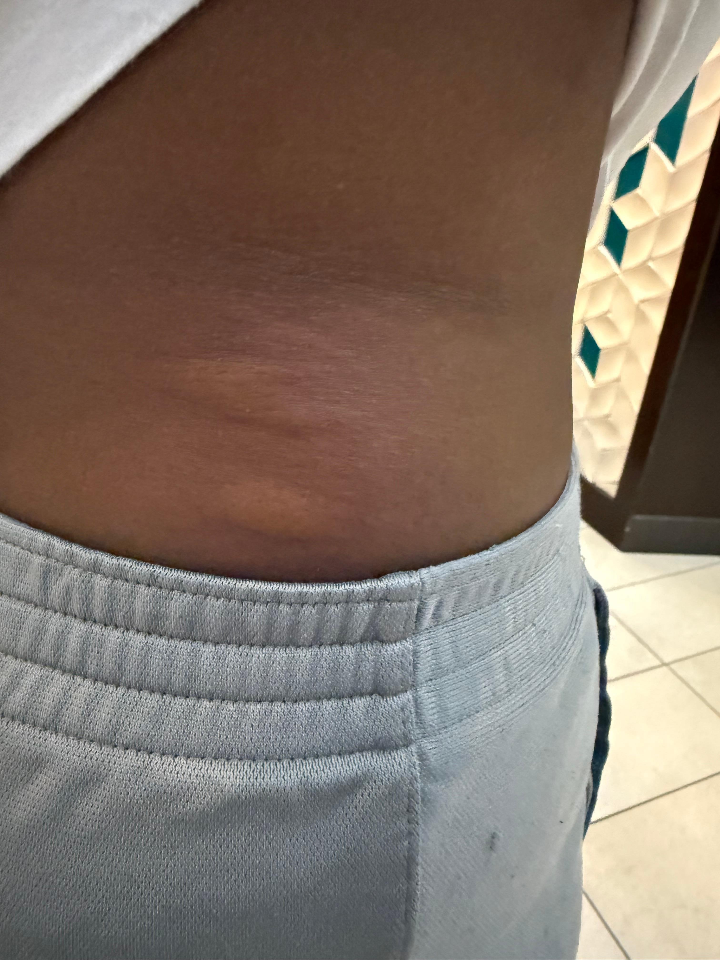 Reaction to bed bug bites 