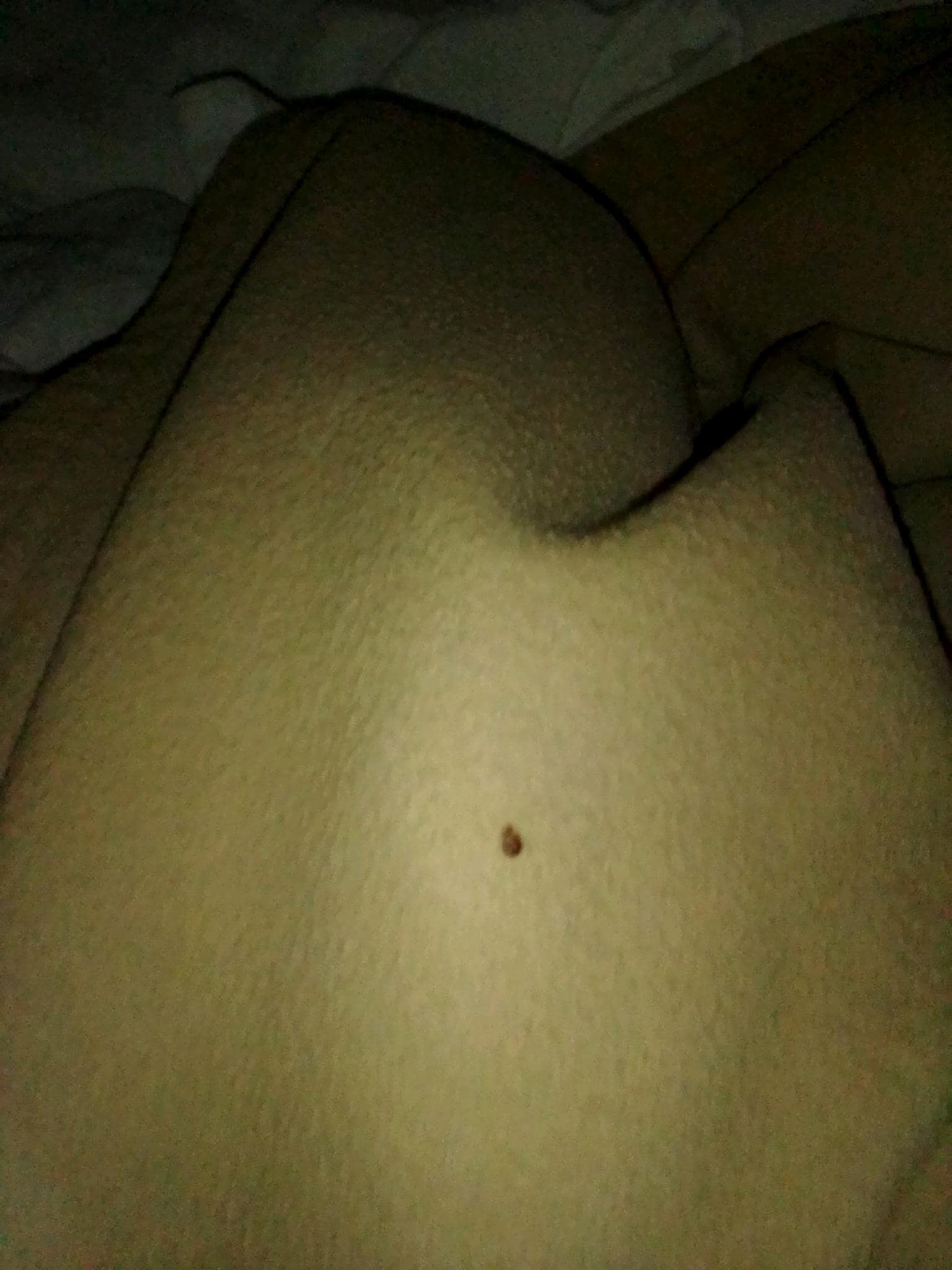 Bed bug on my child’s pillow