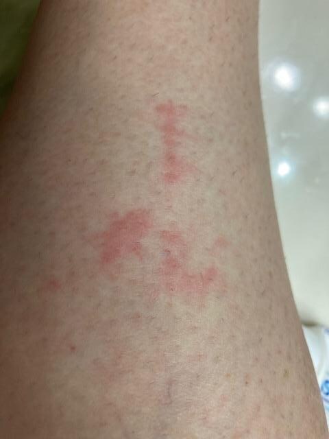 Additional bites that appeared three days after checkout
