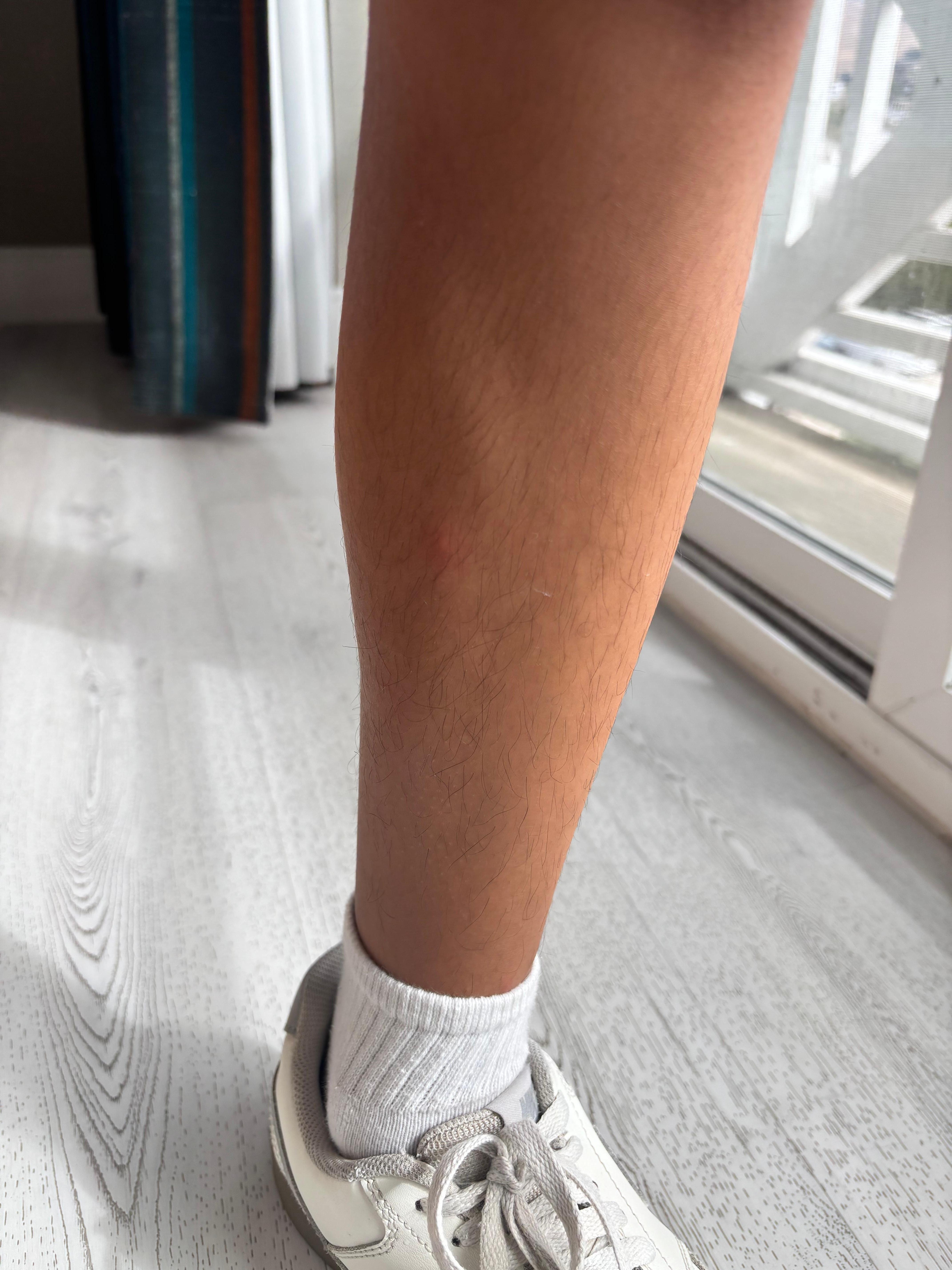 Random bites on his legs after the first night