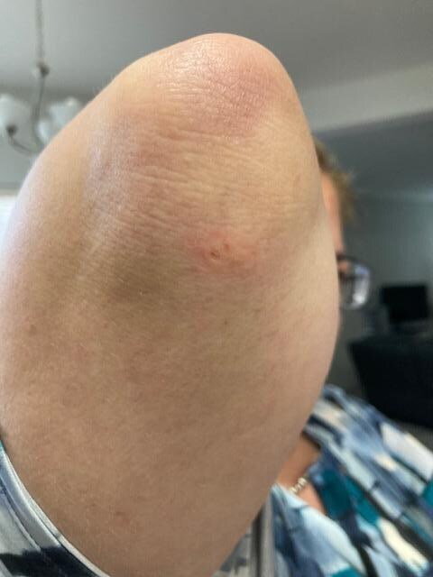 Picture of the bite that appeared two days after checkout