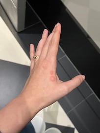 Because of the bed bugs and i had all over my body