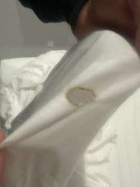 Nos encontramos en la sábana un agujero de una quemadura